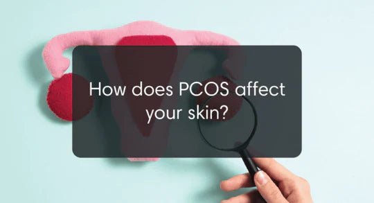 How Does PCOS Affect Your Skin? – Satvin Ayurveda